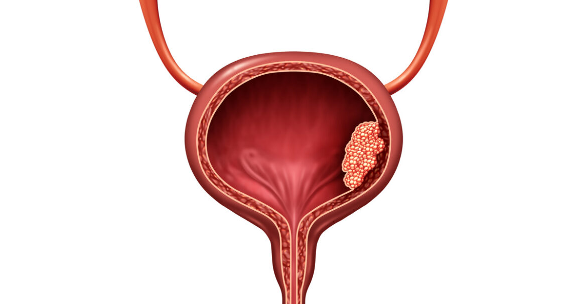 Bladder Cancer | Urologic Oncologist | Dr. Michael Daneshvar | UCI Urology